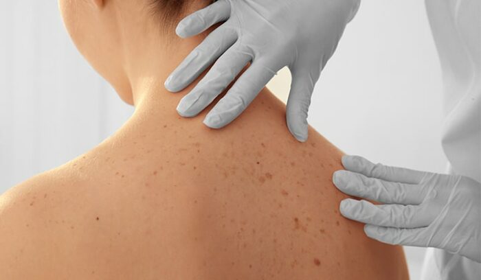 Uneven Skin Tone & Pigmentation at Global Skin Clinics