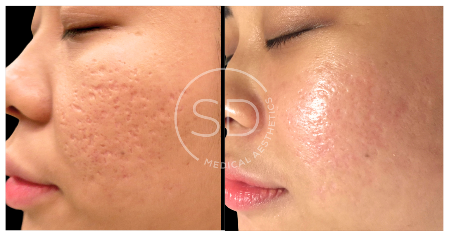 Skin Needling at Global Skin Clinics