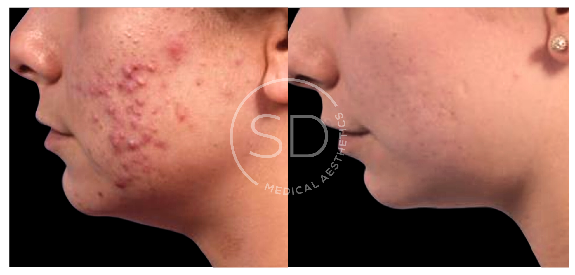 Skin Needling at Global Skin Clinics