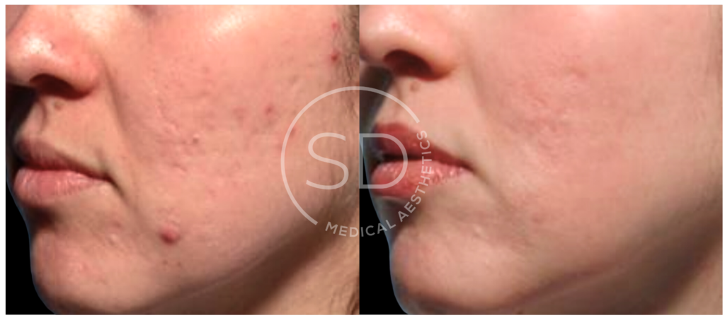 Skin Needling at Global Skin Clinics