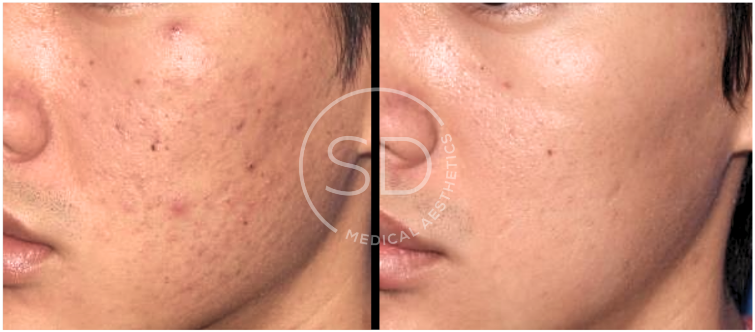Skin Needling at Global Skin Clinics