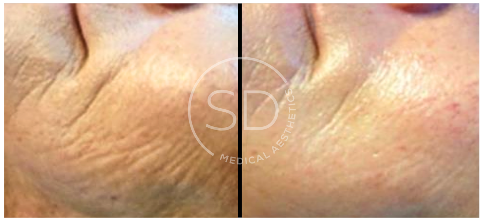 Skin Needling at Global Skin Clinics