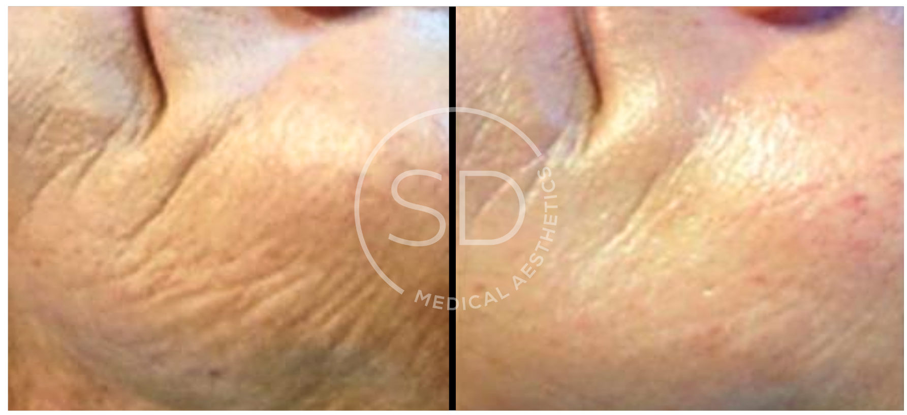 Skin Needling at Global Skin Clinics