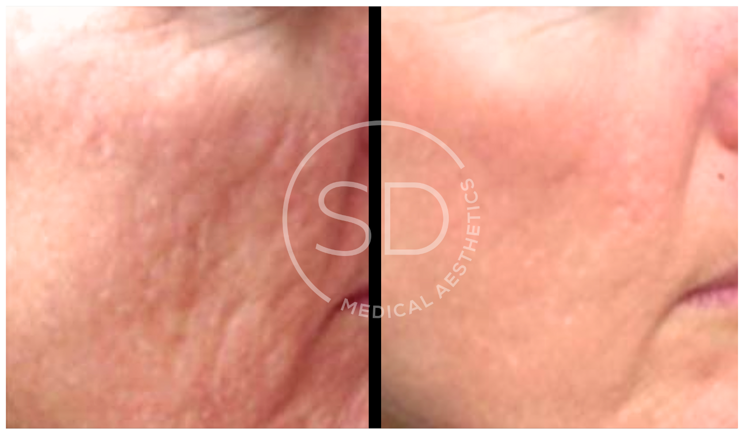 Skin Needling at Global Skin Clinics