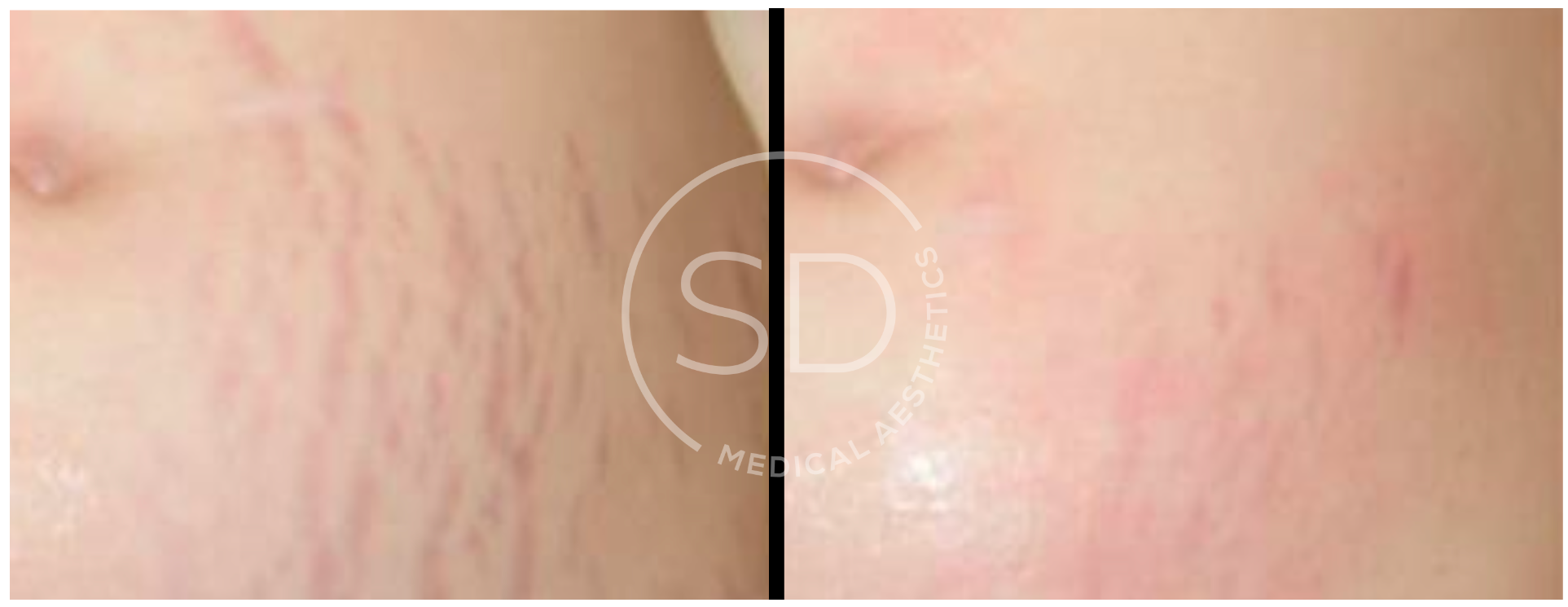 Skin Needling at Global Skin Clinics